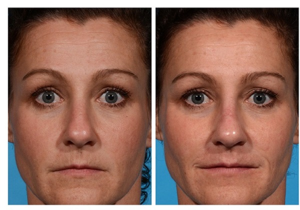 Understanding Liquid Rhinoplasty