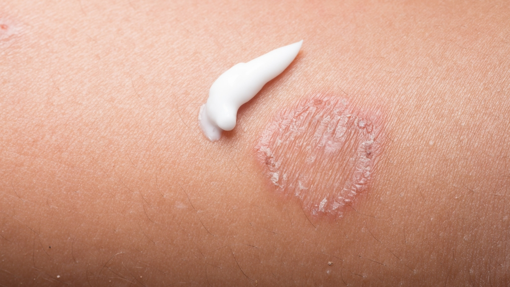 What Is Cellulitis The Dangers Signs And Symptoms To Watch Out For