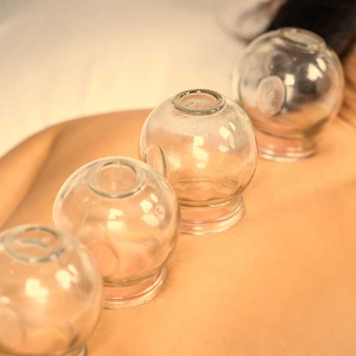 Cupping Therapy - Acupuncture Healing Center