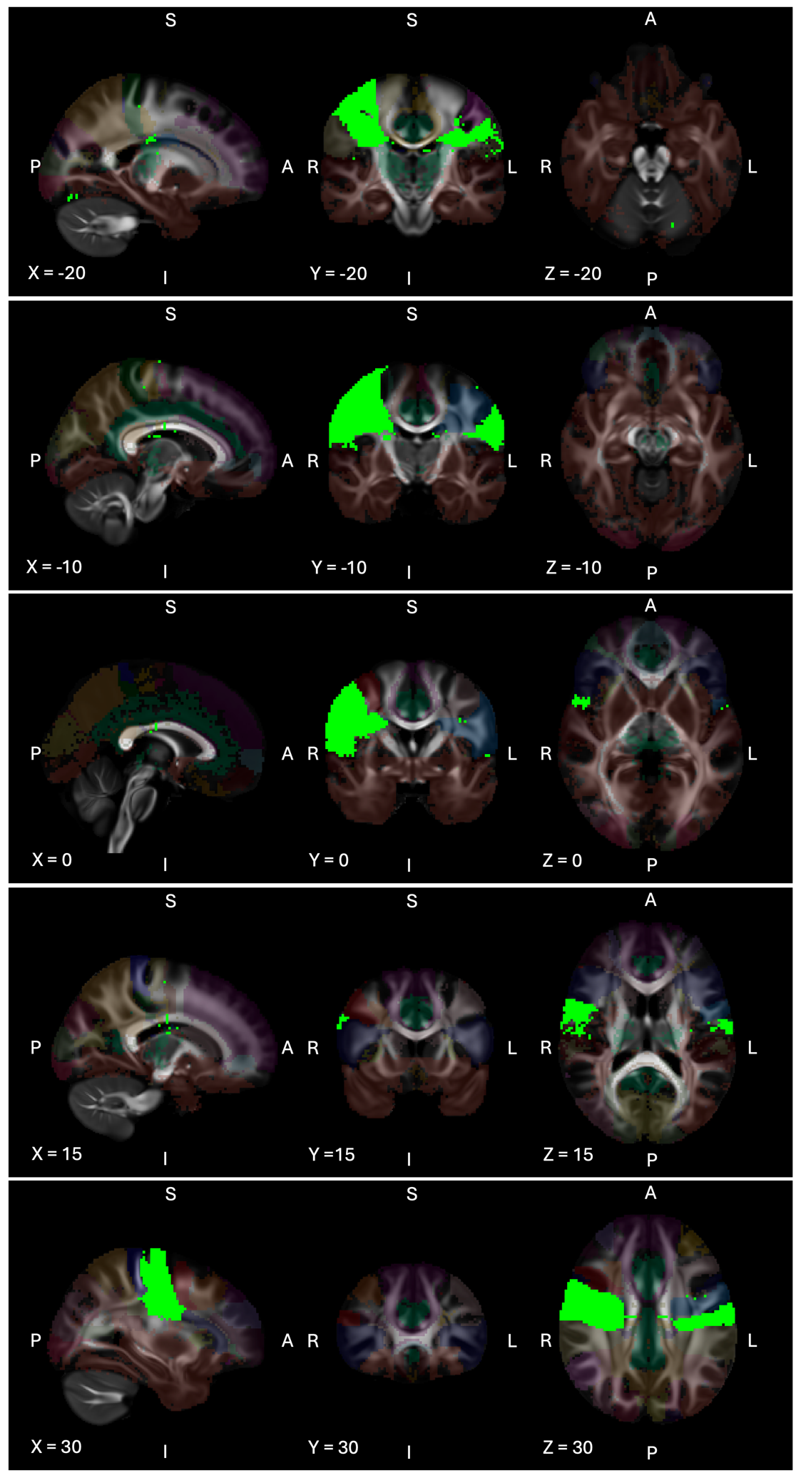 Commissural Parcellation Parcel 9