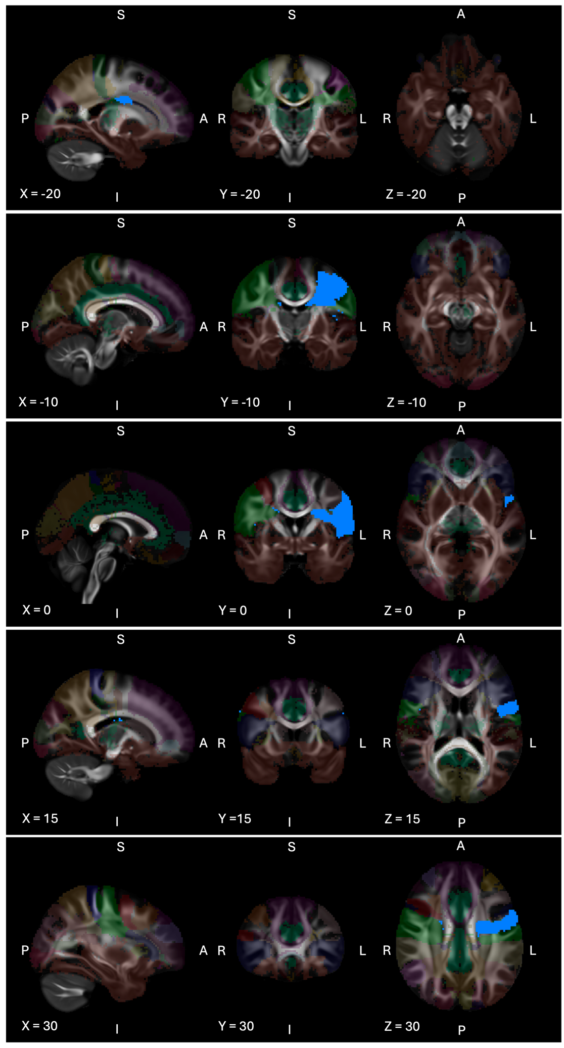Commissural Parcellation Parcel 24