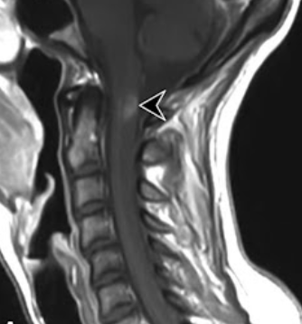 Intervertebral Disc Bulges by Patricia Hunt
