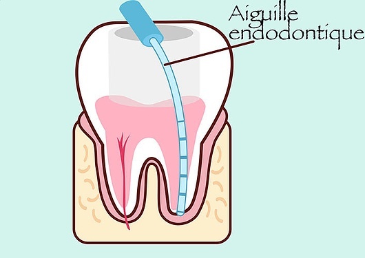 Dévitaliser une dent: est-ce que ça fait mal & combien ça coûte