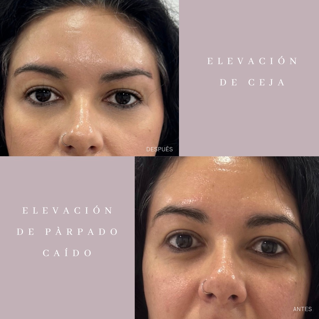 Elevación de cejas