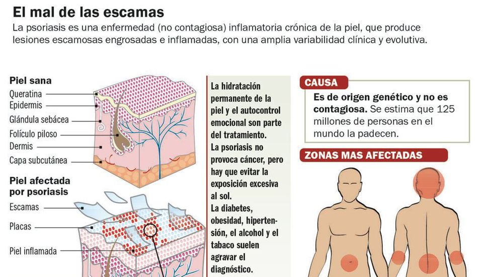 La psoriasis, un mal que deja huella • Diario Democracia