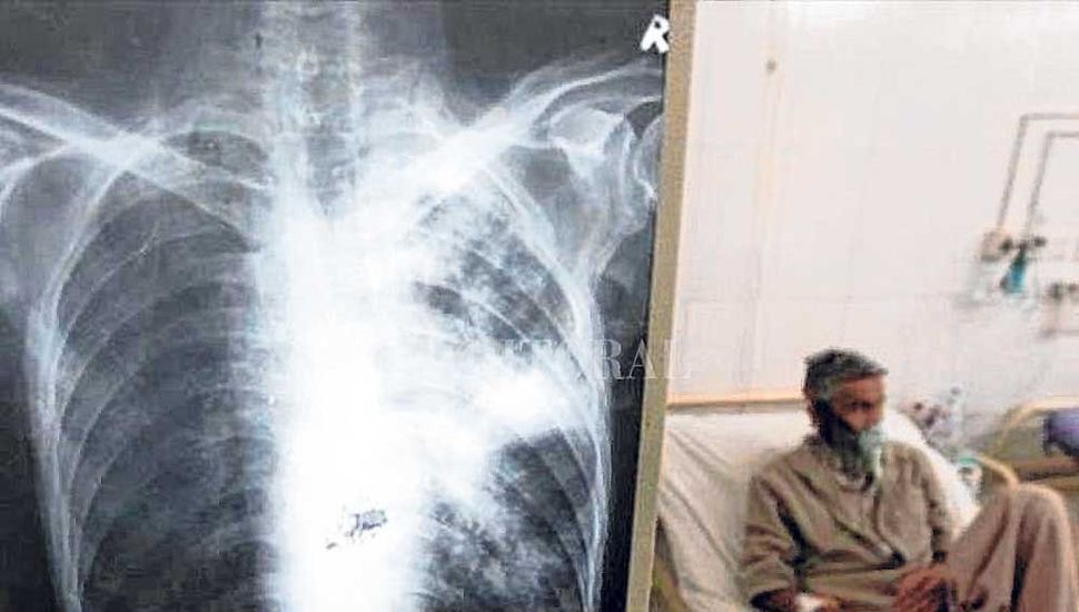 Tuberculosis multirresistente: una amenaza mundial que va en aumento ...