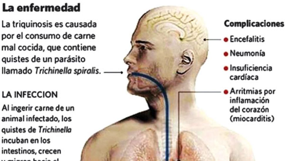 Triquinosis en Junín: aparecen nuevos casos y en un paciente ya dio ...