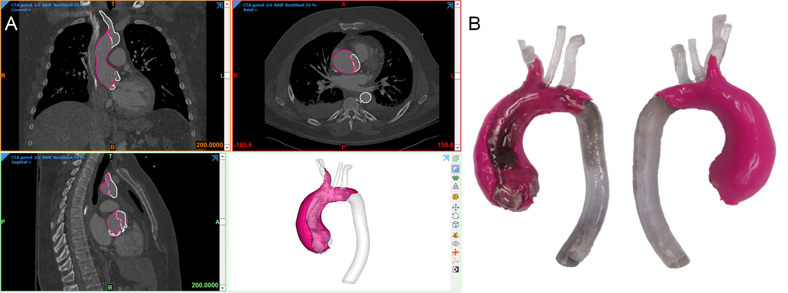3D Printed Anatomic Models and Guides - Clinical Tree