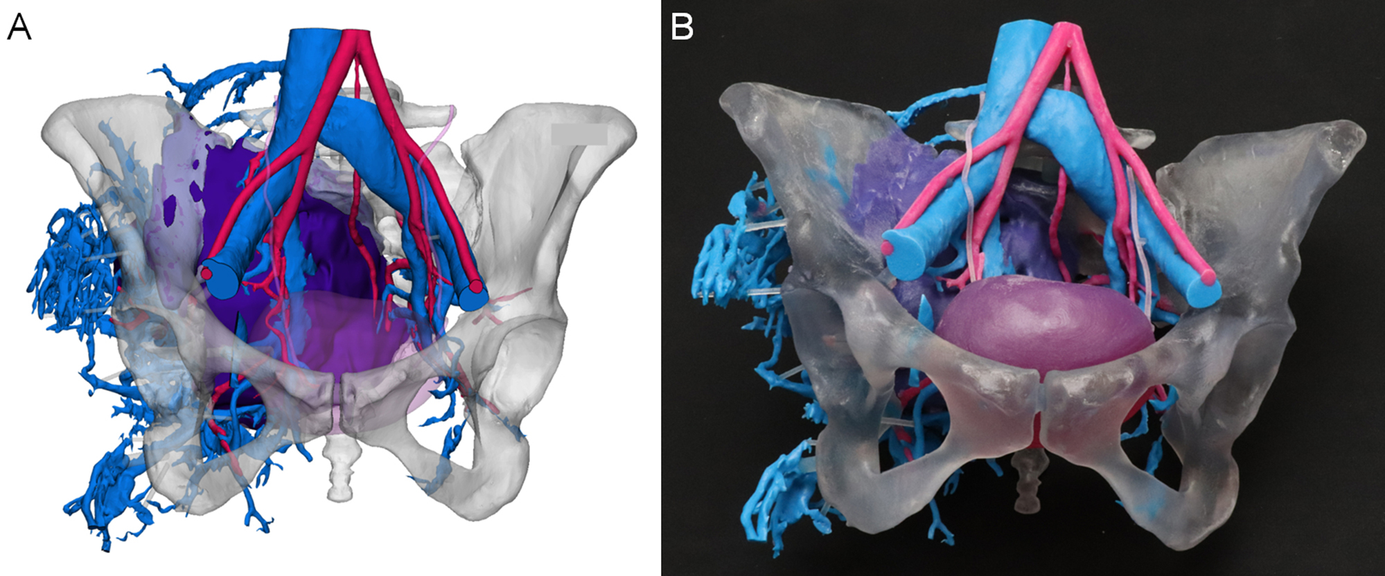 3D Printed Anatomic Models and Guides - Clinical Tree