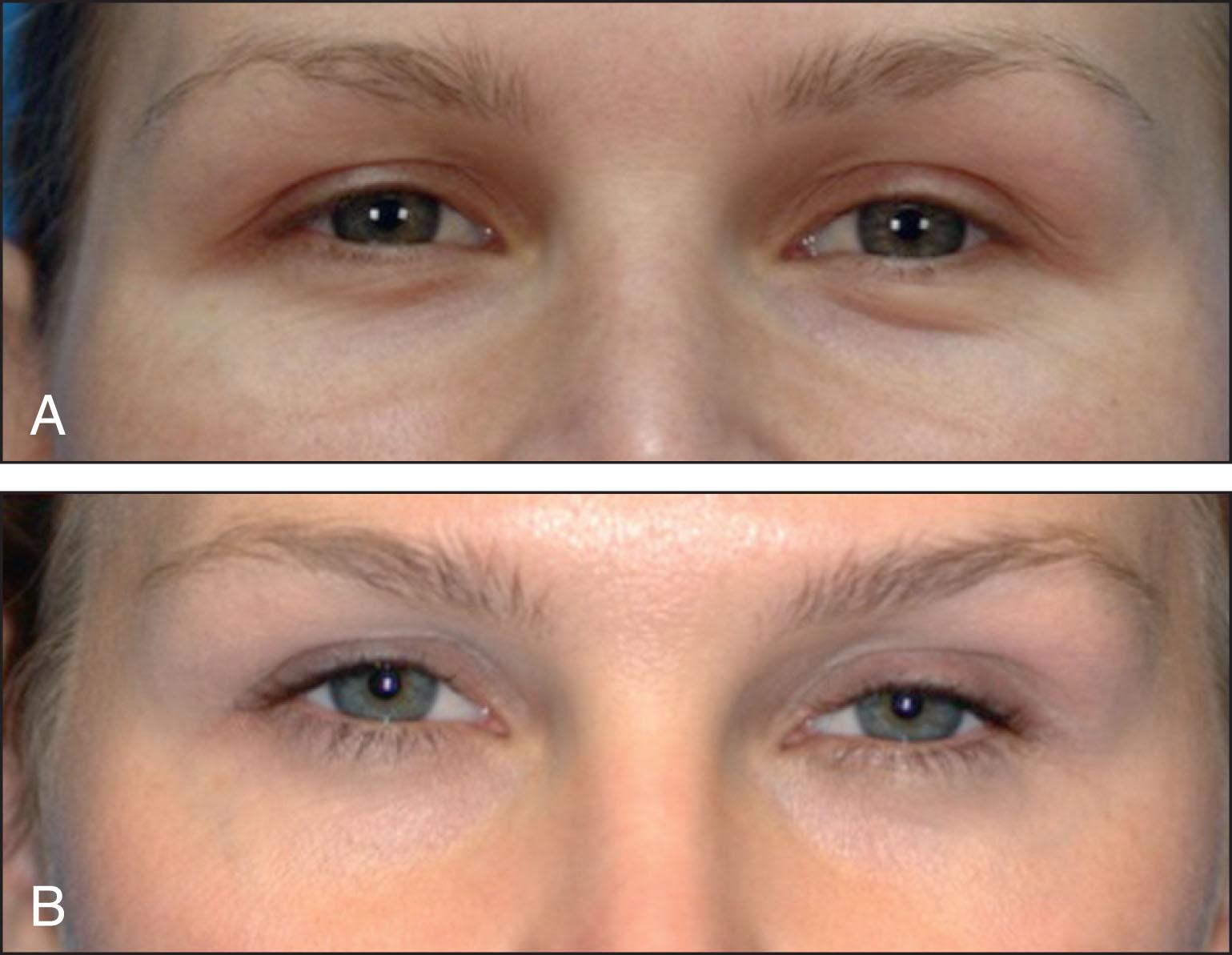 Ablative Laser Skin Resurfacing - Clinical Tree
