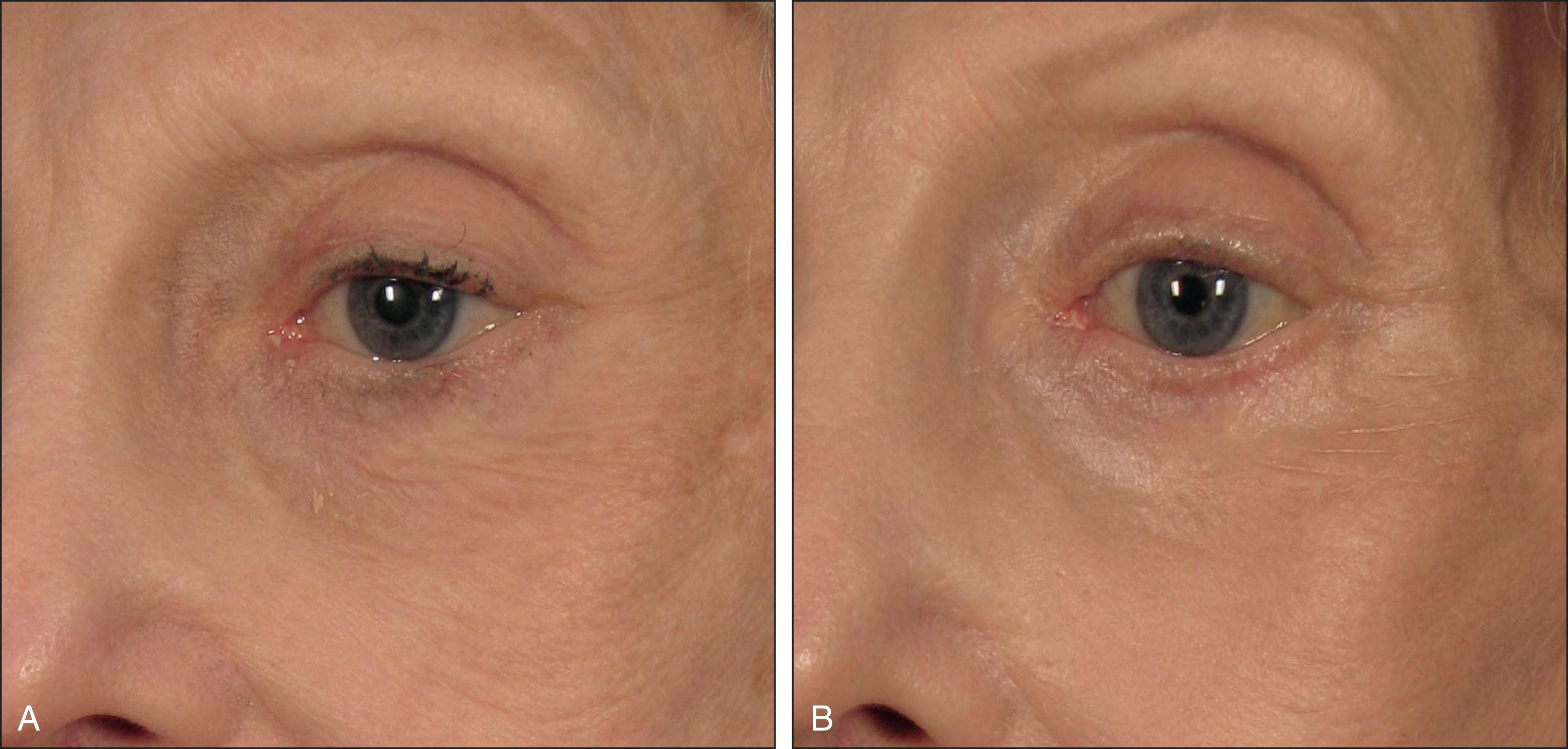 Ablative Laser Skin Resurfacing - Clinical Tree