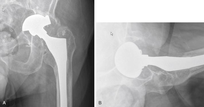Acetabular Reconstruction With a Jumbo Socket - Clinical Tree