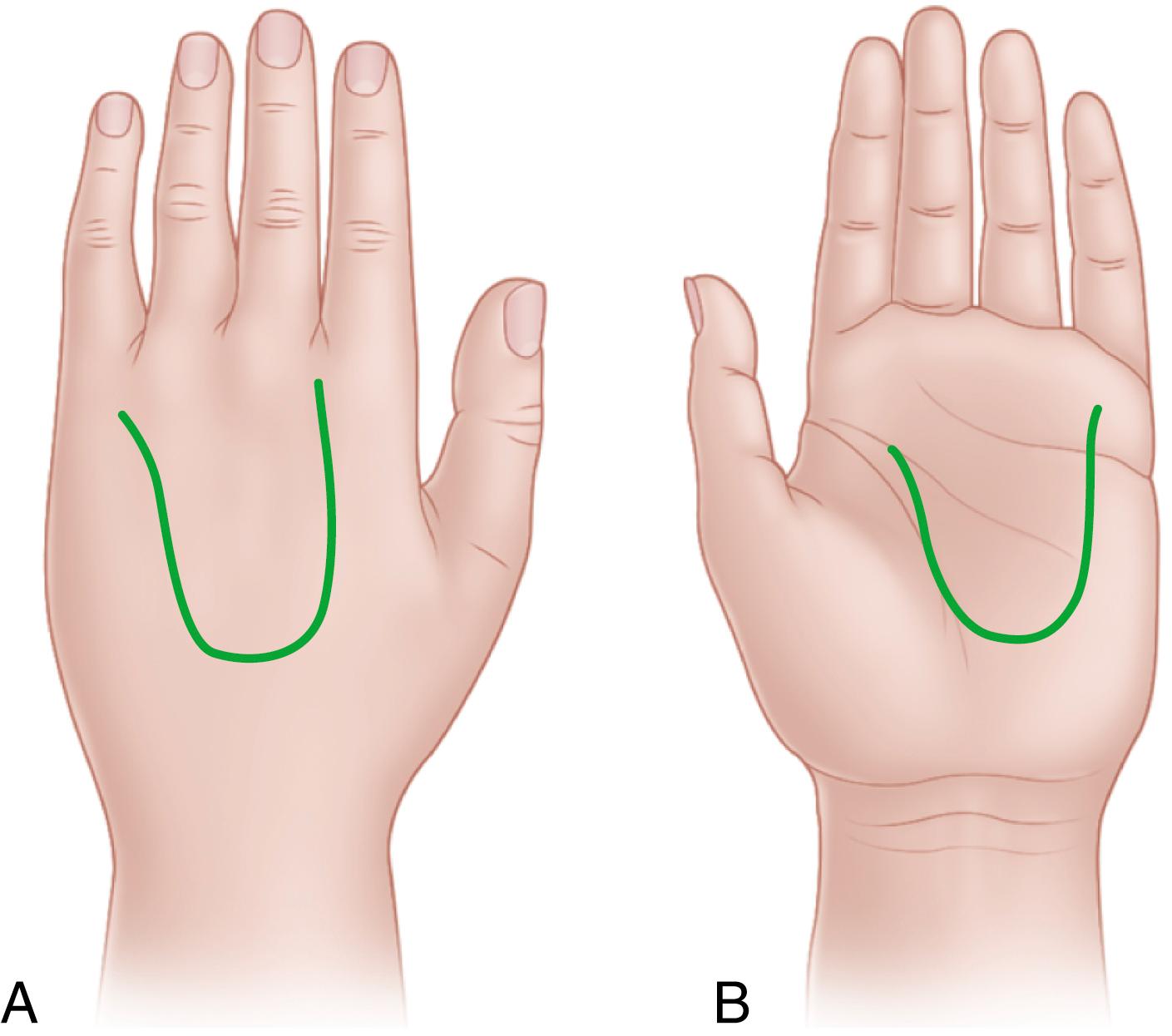 Acute Hand Injuries - Clinical Tree