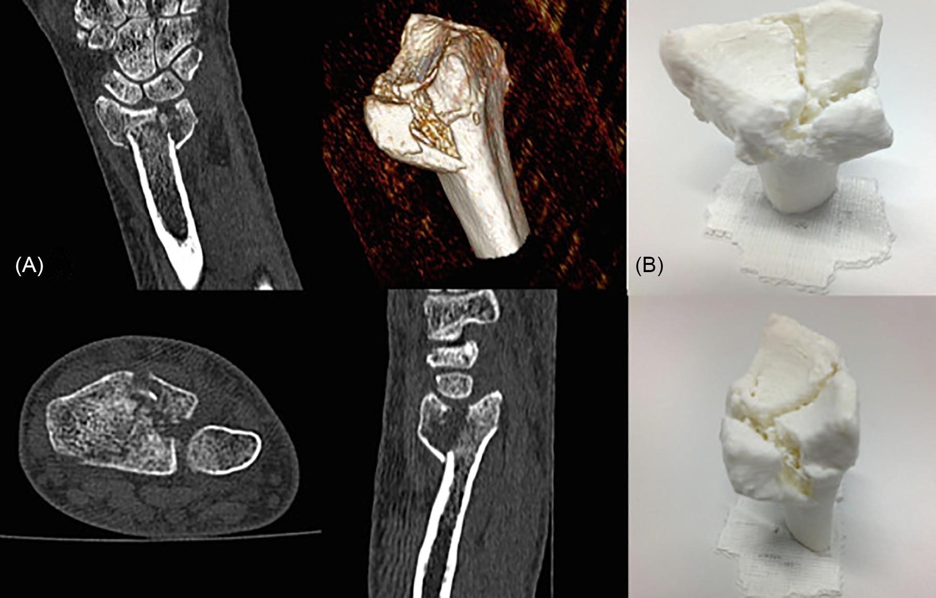 Advanced Imaging in Distal Radius Fractures - Clinical Tree