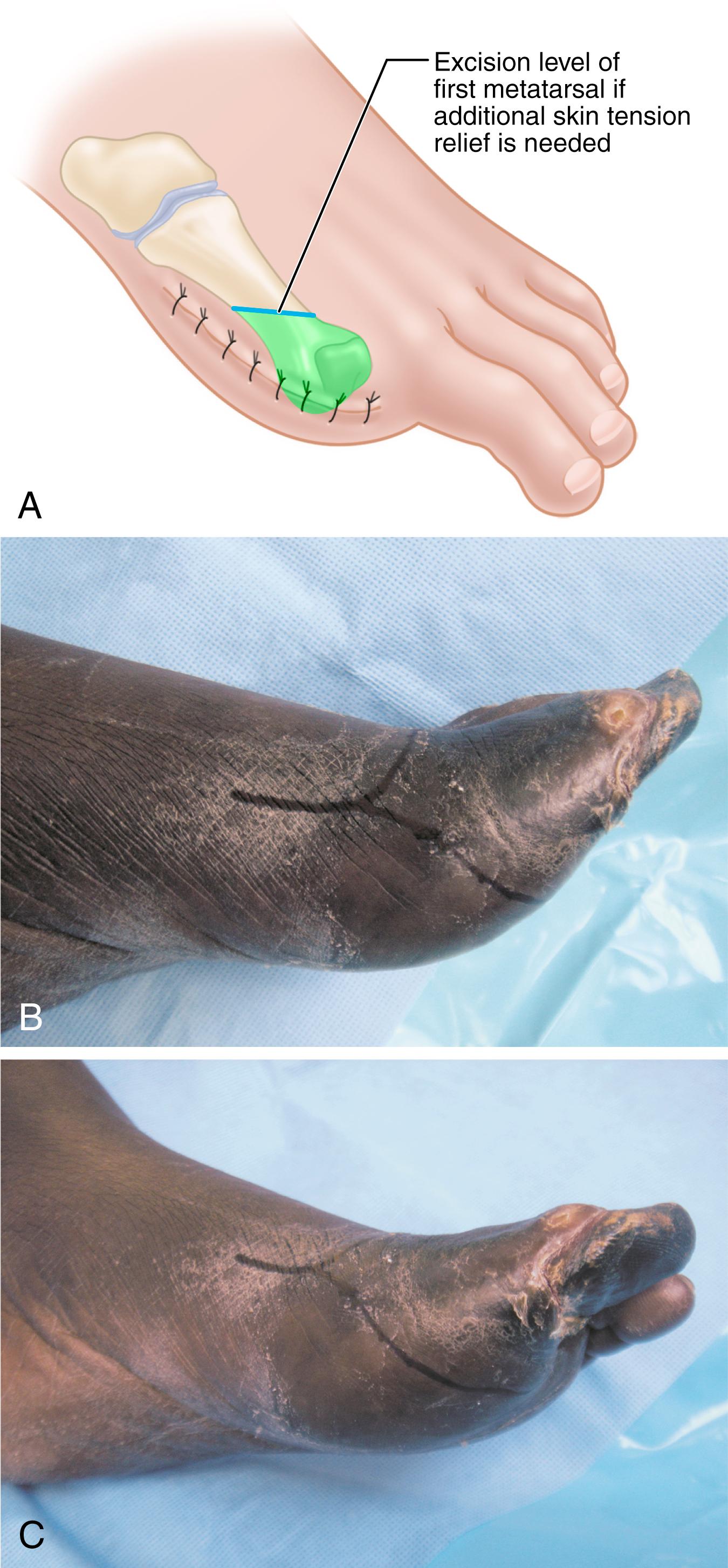 Amputations of the Foot - Clinical Tree