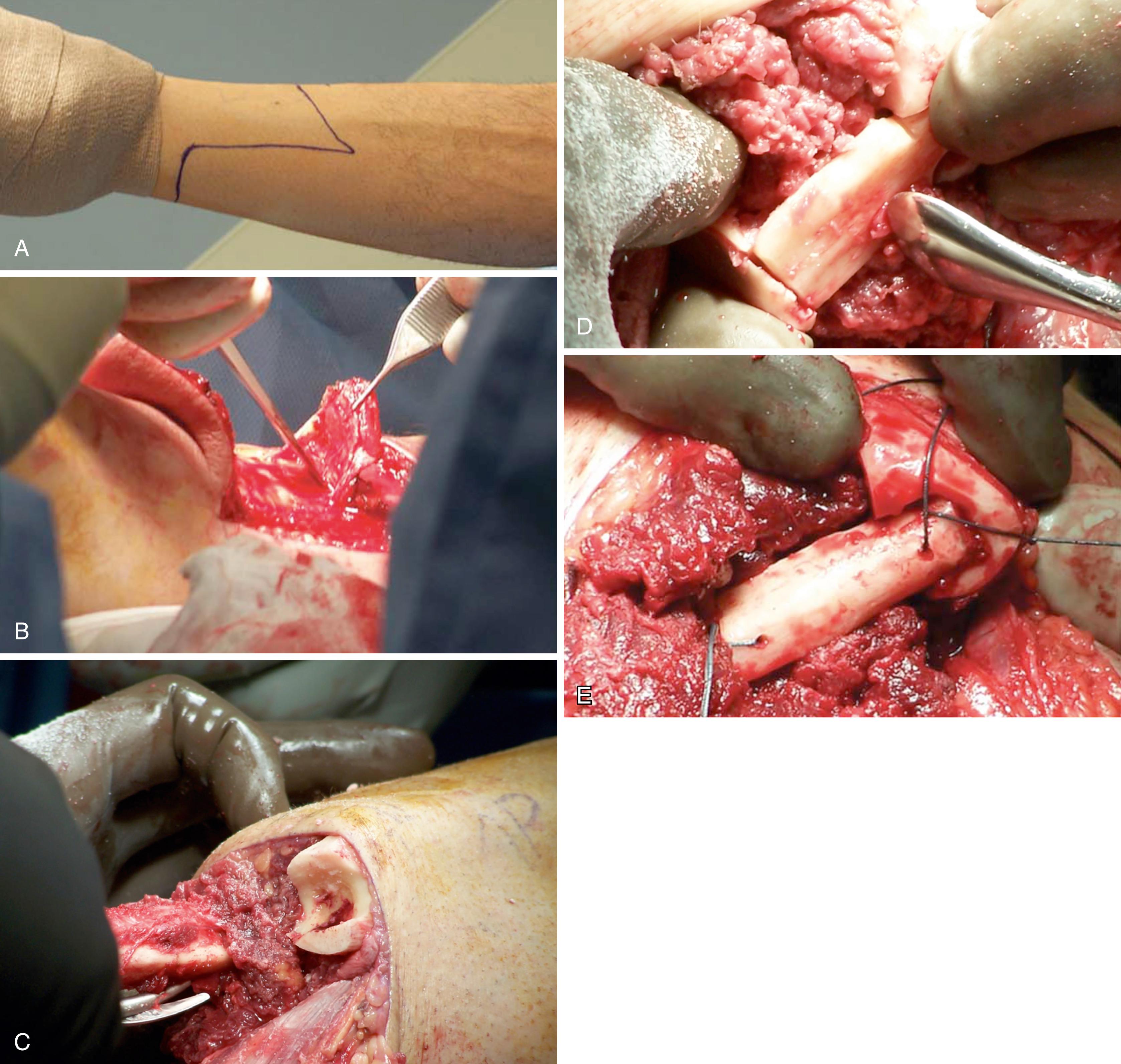 Amputations of the Lower Extremity - Clinical Tree