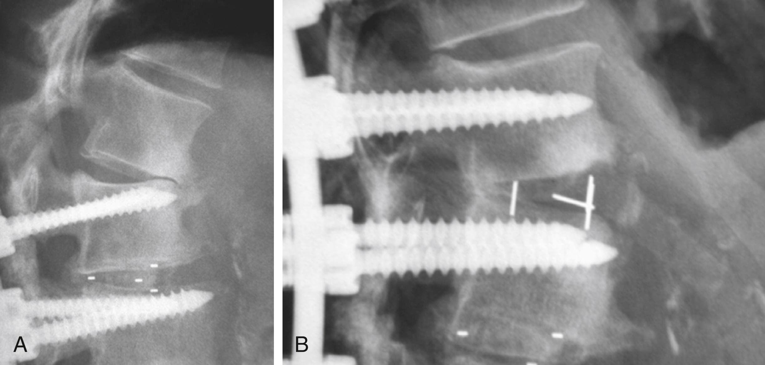 An Approach for Treatment of Complex Adult Spinal Deformity - Clinical Tree