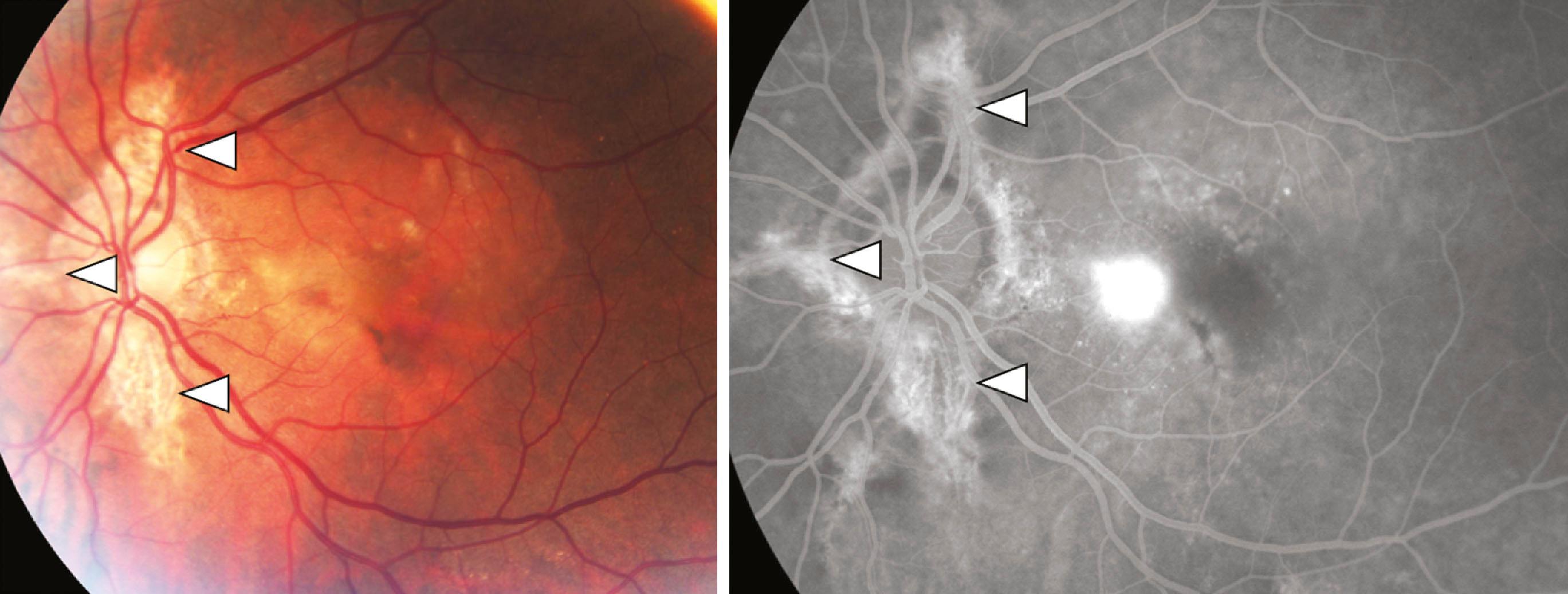 Angioid Streaks - Clinical Tree