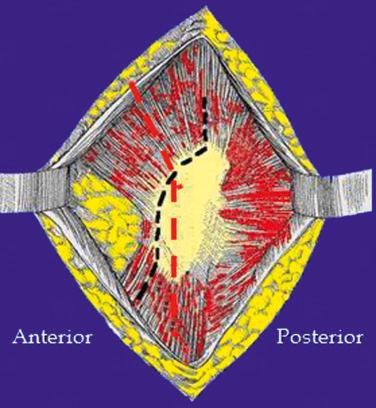 Anterolateral Approach for Primary Total Hip Replacement - Clinical Tree