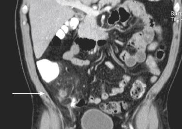 Appendectomy – Open - Clinical Tree