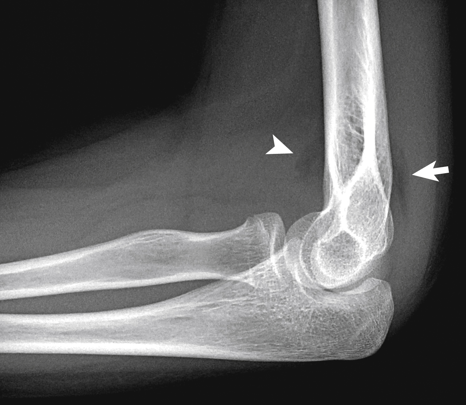Approach to Pediatric Elbow - Clinical Tree
