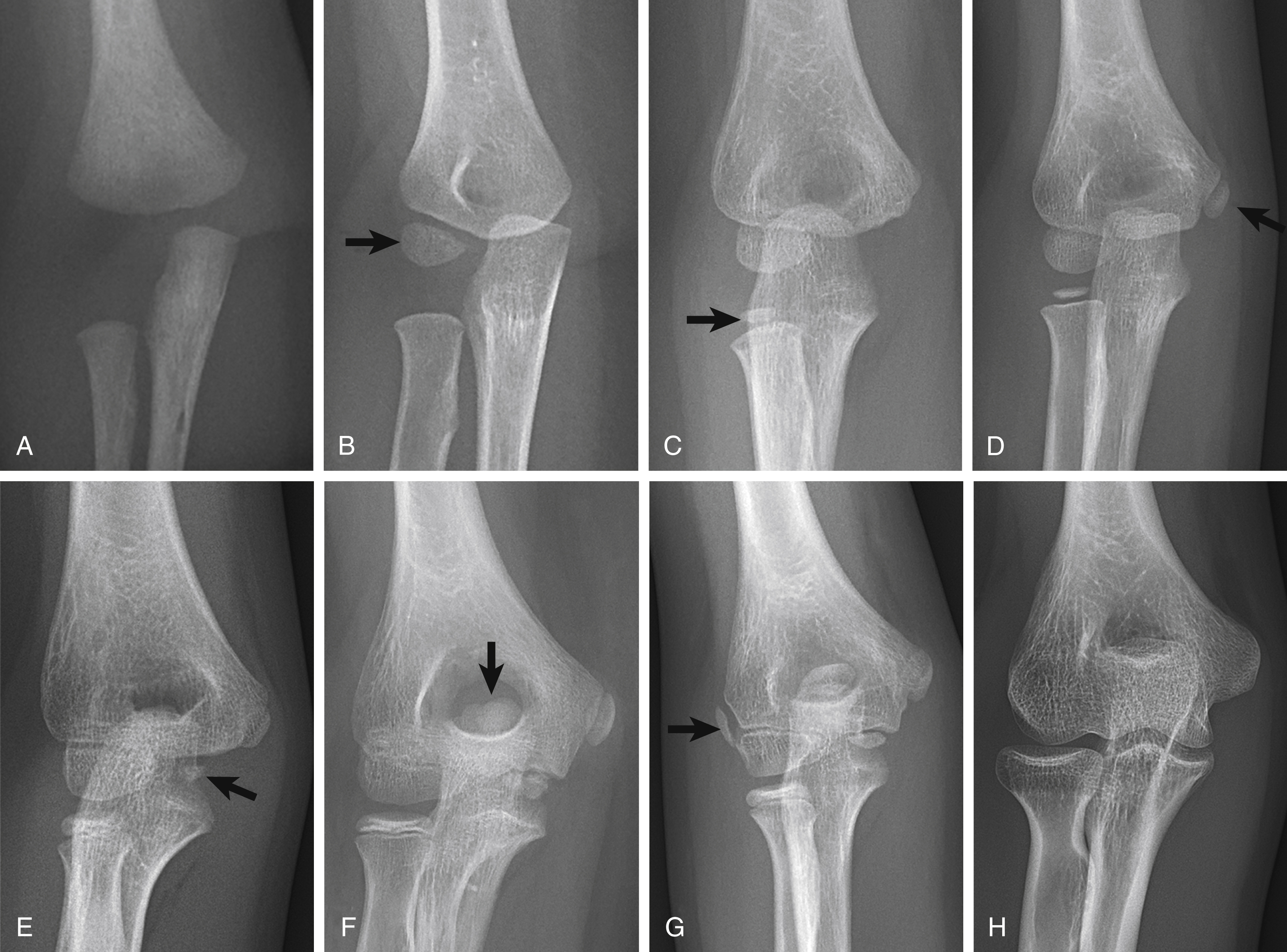 Approach to Pediatric Elbow - Clinical Tree