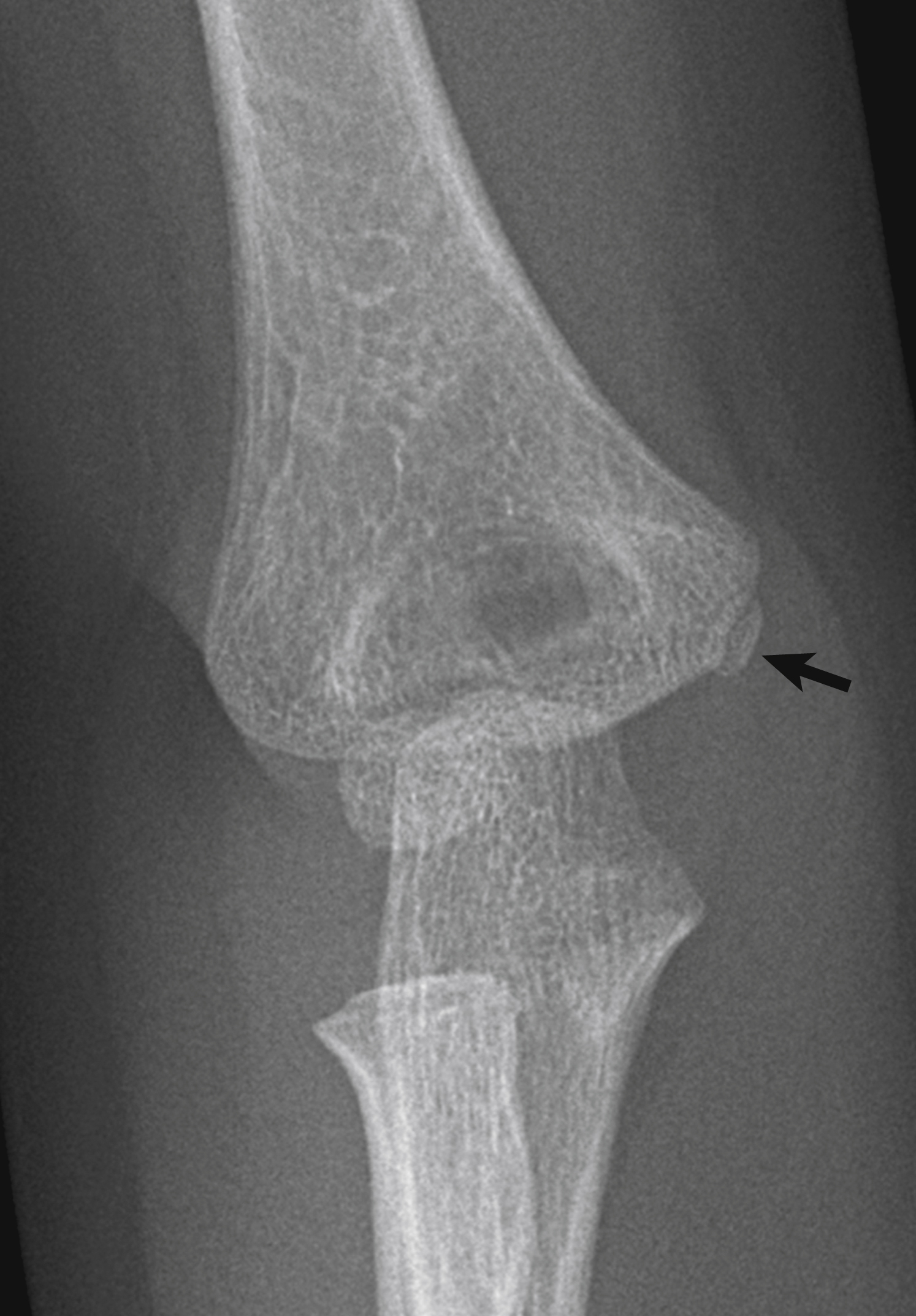 Approach to Pediatric Elbow - Clinical Tree