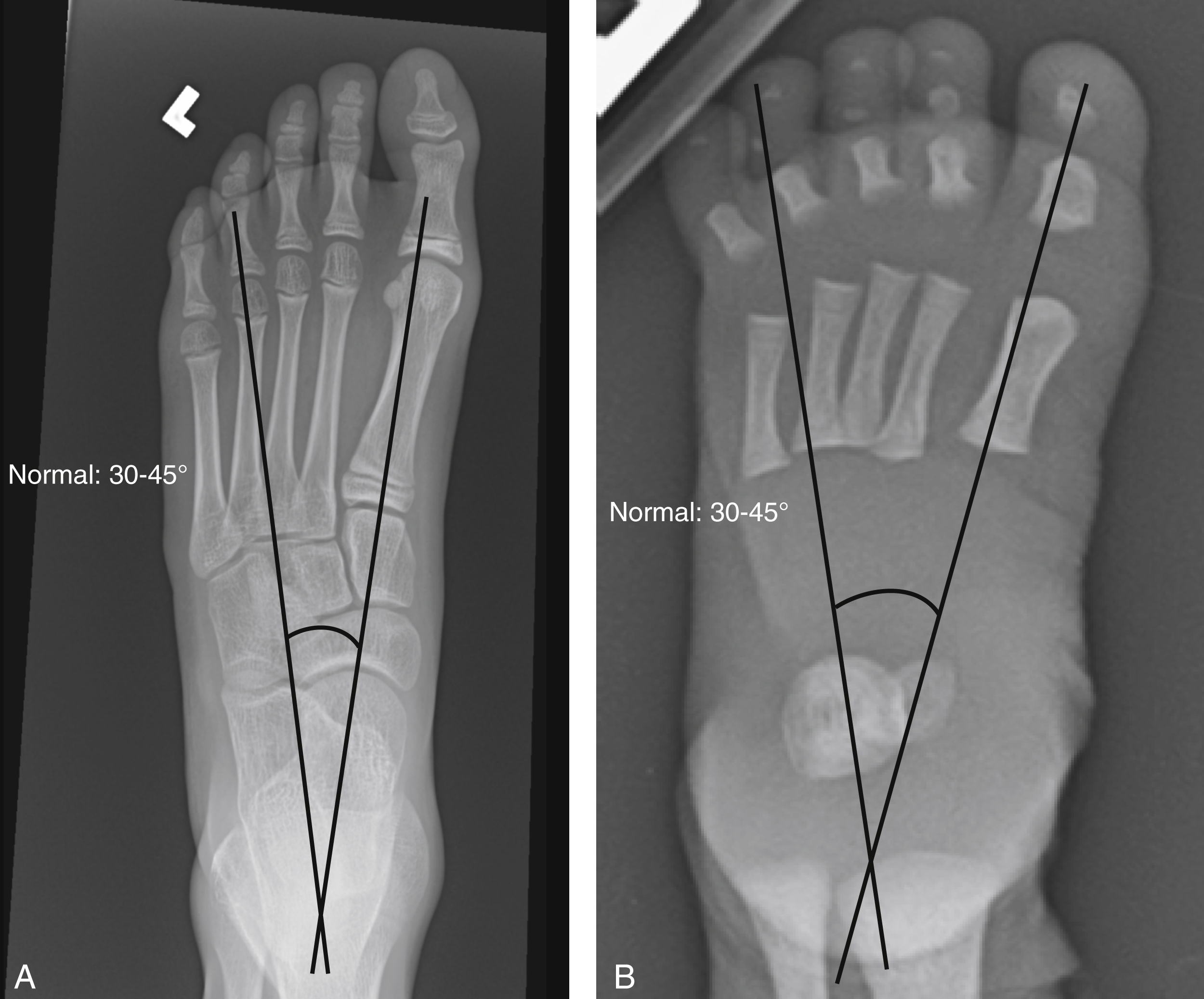 Approach to Pediatric Foot - Clinical Tree