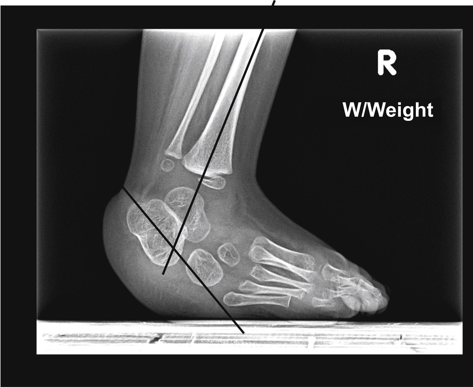 Approach to Pediatric Foot - Clinical Tree