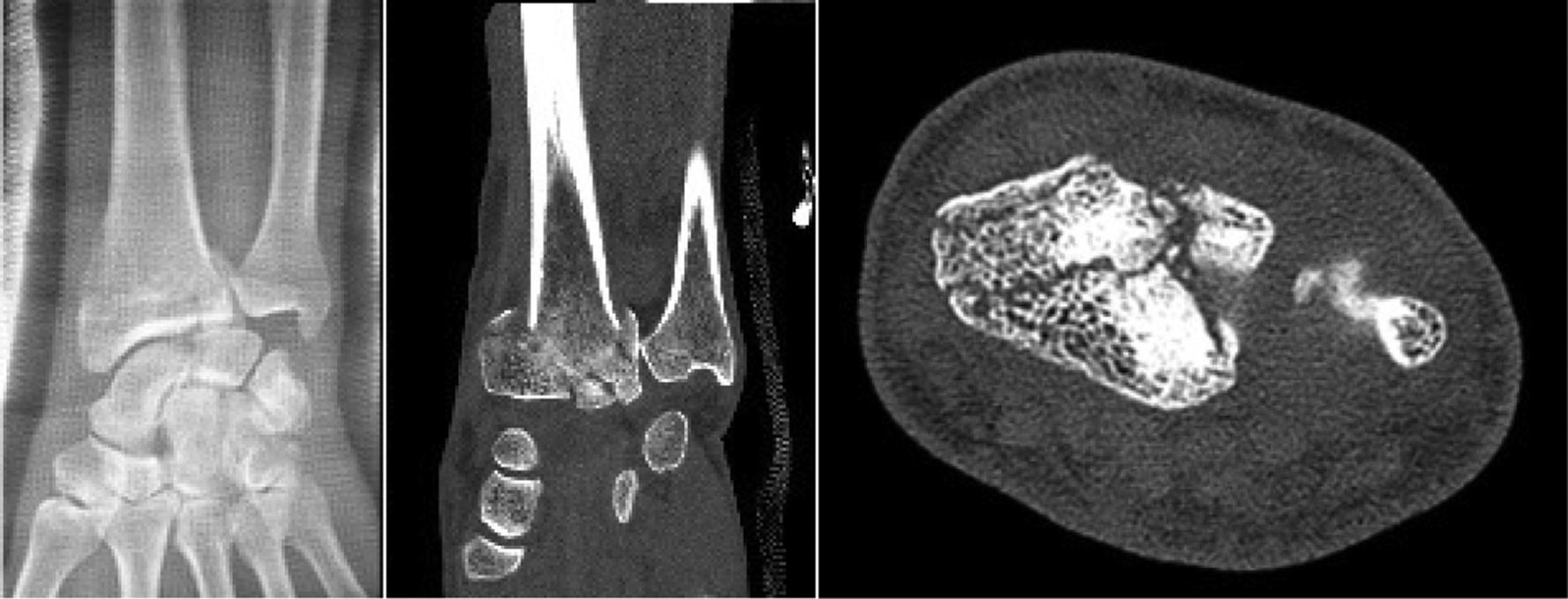 Arthroscopic Assisted Treatment Of Distal Radius Fractures Clinical Tree