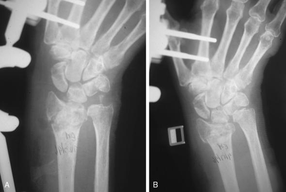 Arthroscopic Treatment Of Distal Radius Fractures Clinical Tree