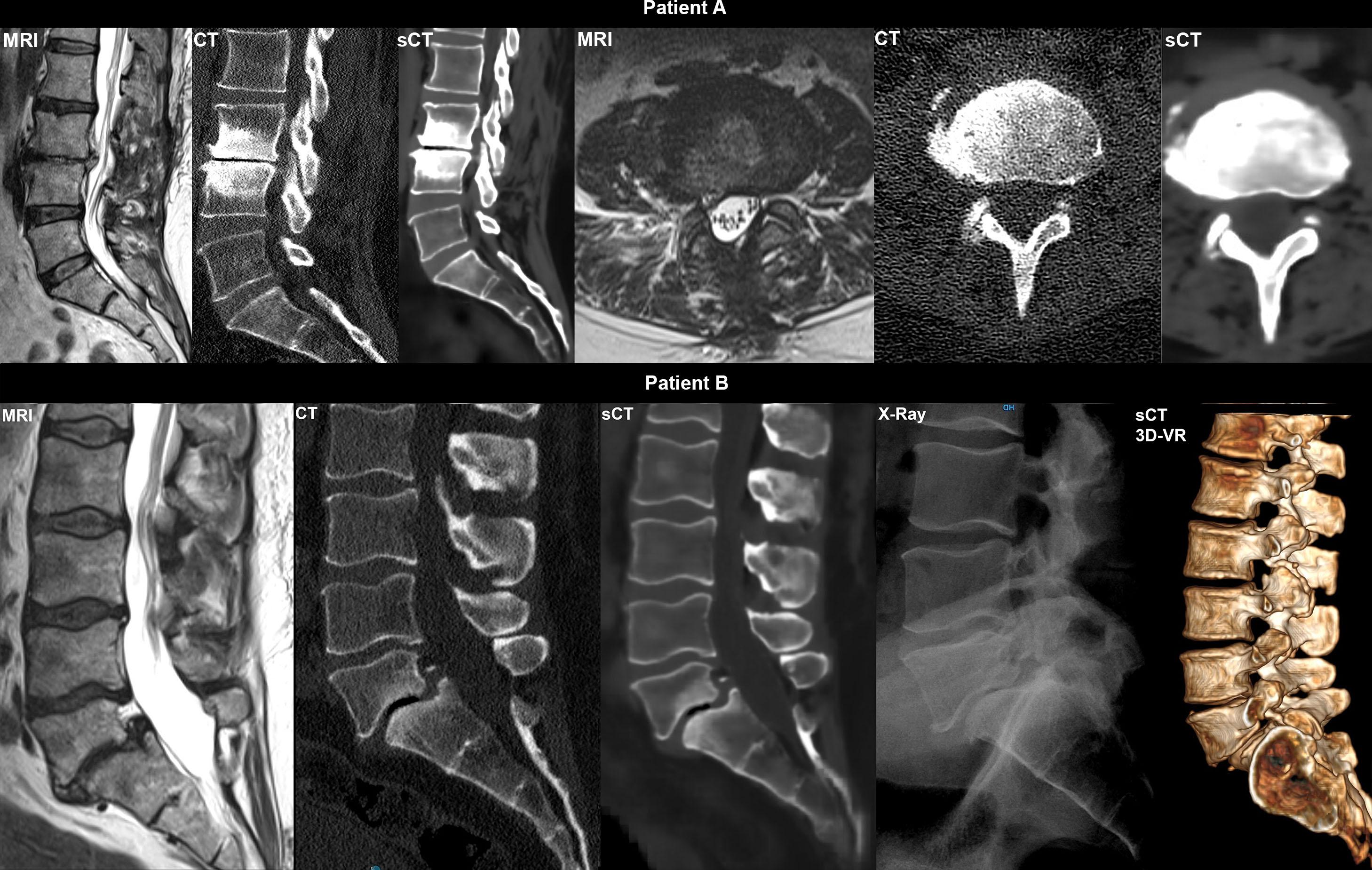 Artificial Intelligence and Machine Learning in Spine Surgery ...