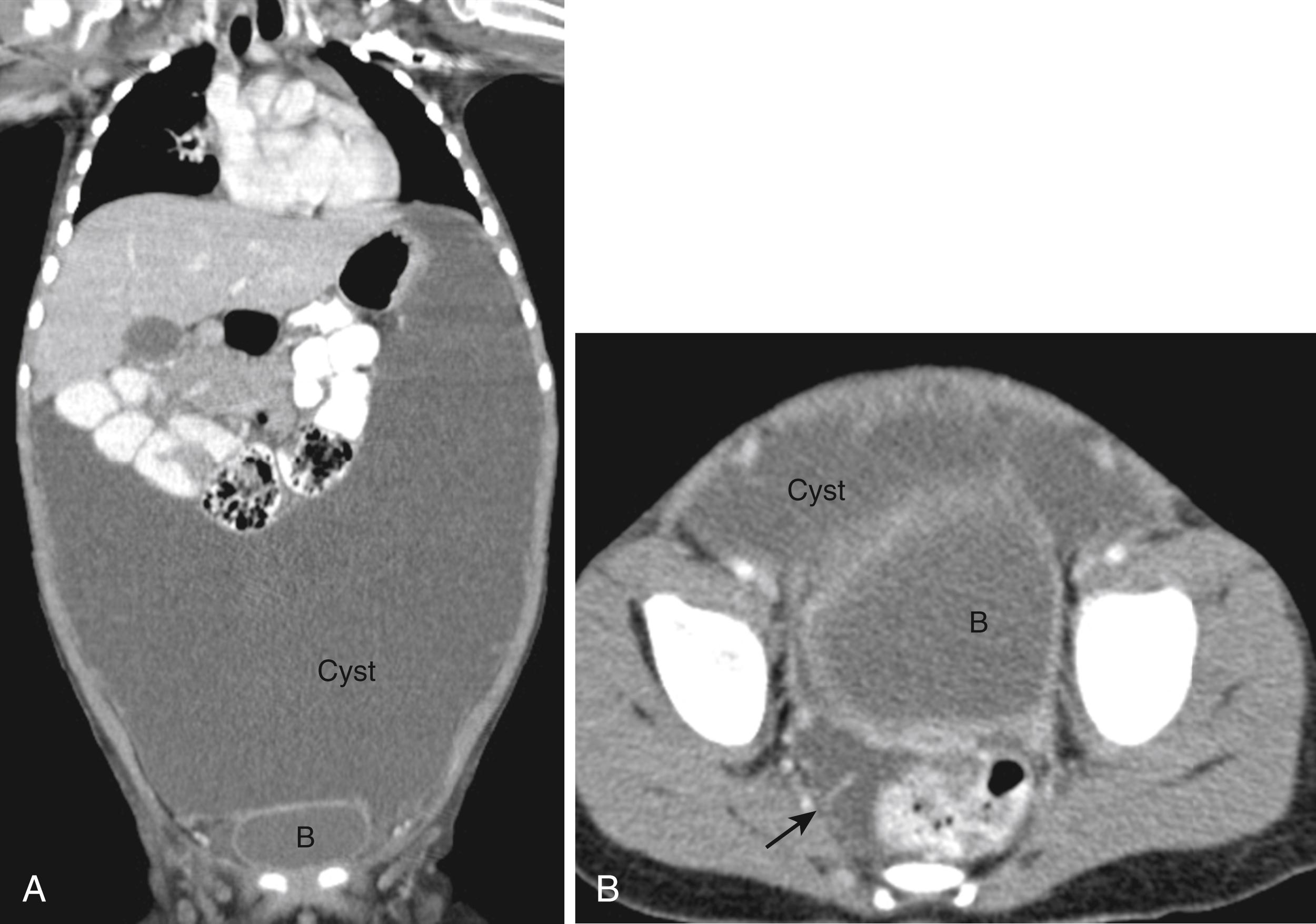 Ascites - Clinical Tree