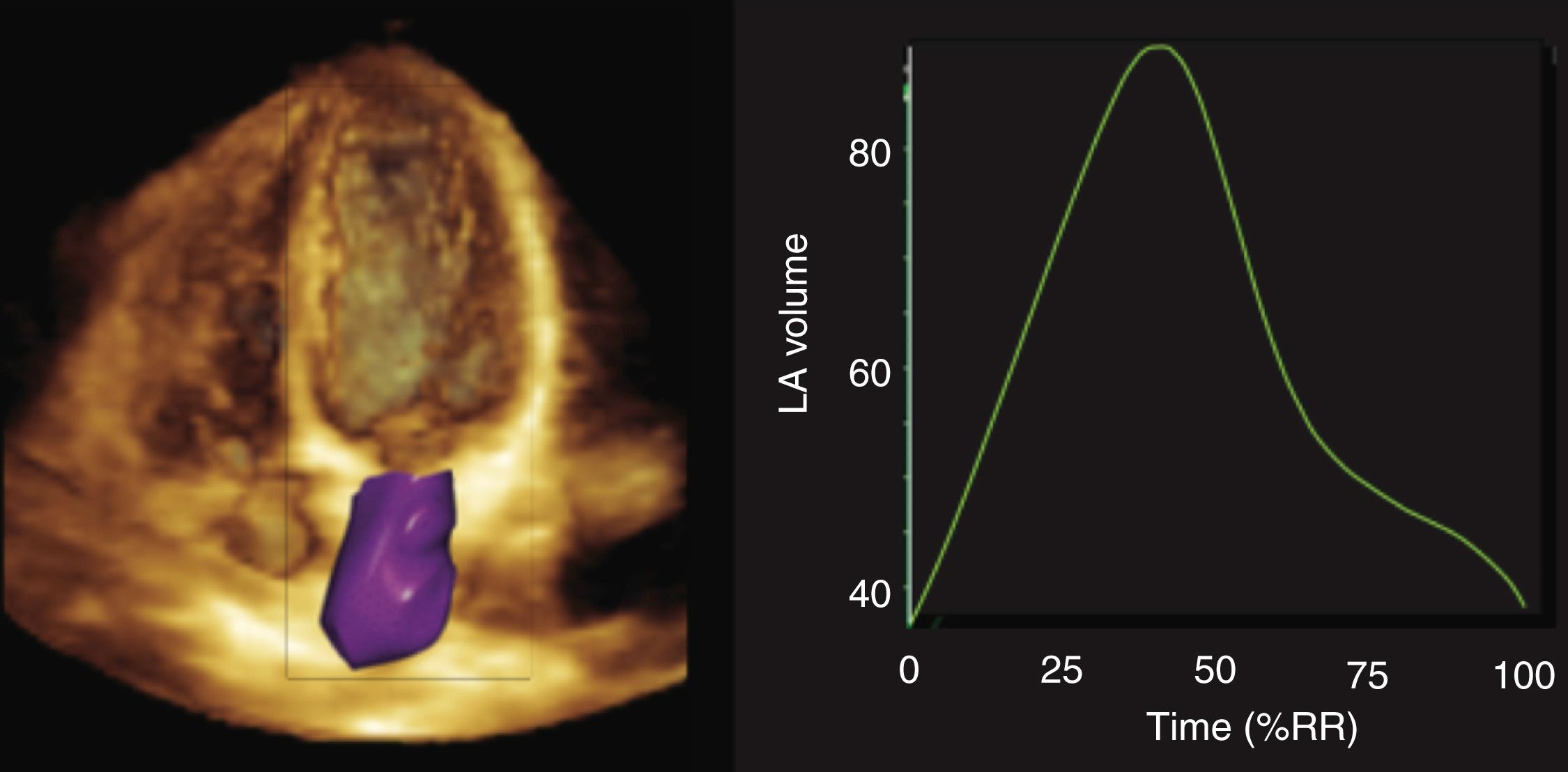 Assessment of Left Atrial Function - Clinical Tree