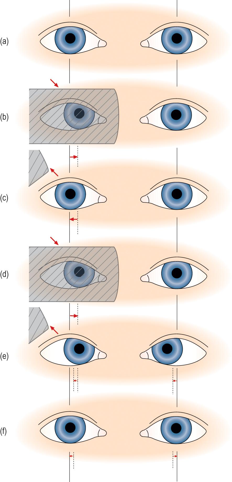 Assessment of binocular vision and accommodation - Clinical Tree