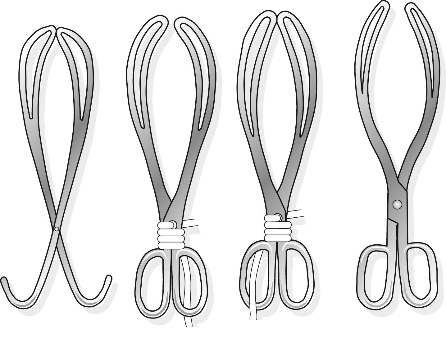 Assisted Vaginal Delivery – an Overview - Clinical Tree