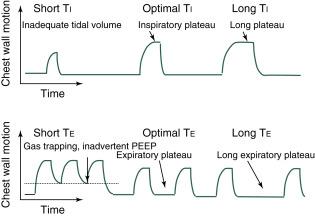 Assisted Ventilation - Clinical Tree
