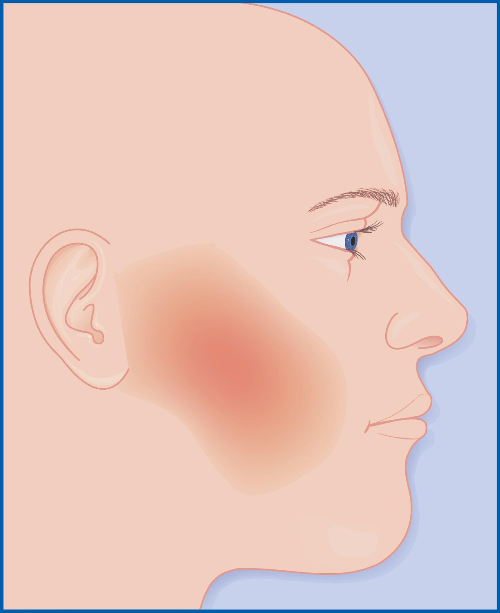 Auriculotemporal Nerve Block for Frey Syndrome - Clinical Tree Auriculotemporal Nerve Block for Frey Syndrome - Clinical Tree