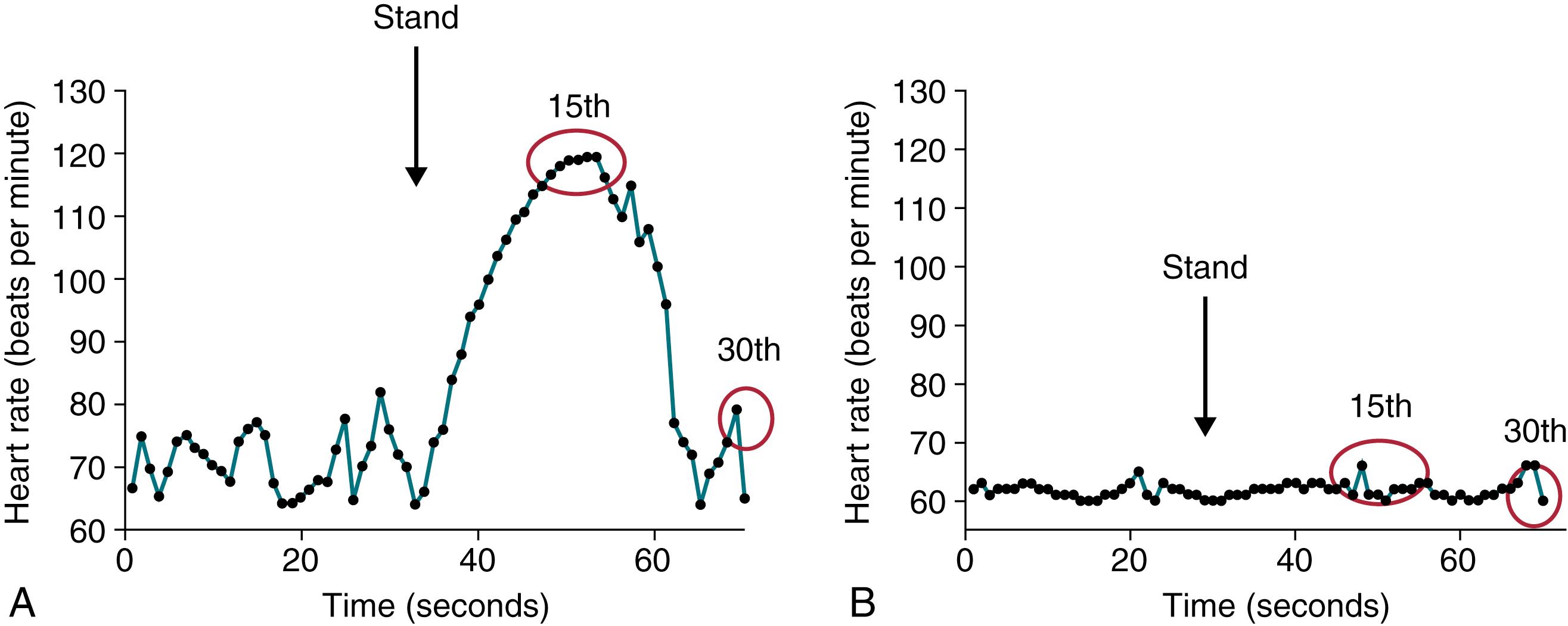 Autonomic Dysfunction in Neuromuscular Disorders - Clinical Tree