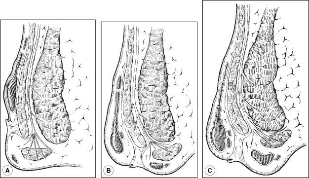 Banding for Internal Hemorrhoids - Clinical Tree