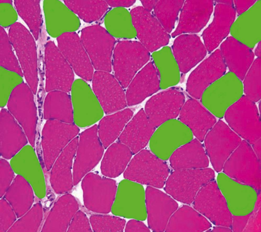 Basic Electromyography: Analysis of Motor Unit Action Potentials ...