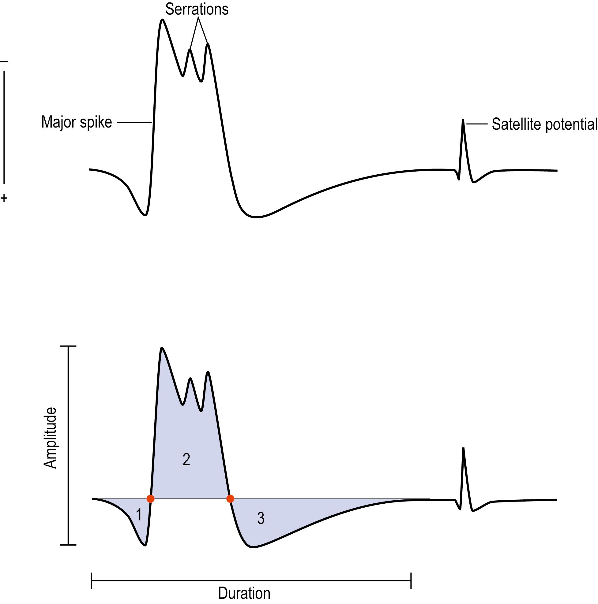 Basic Electromyography: Analysis of Motor Unit Action Potentials ...