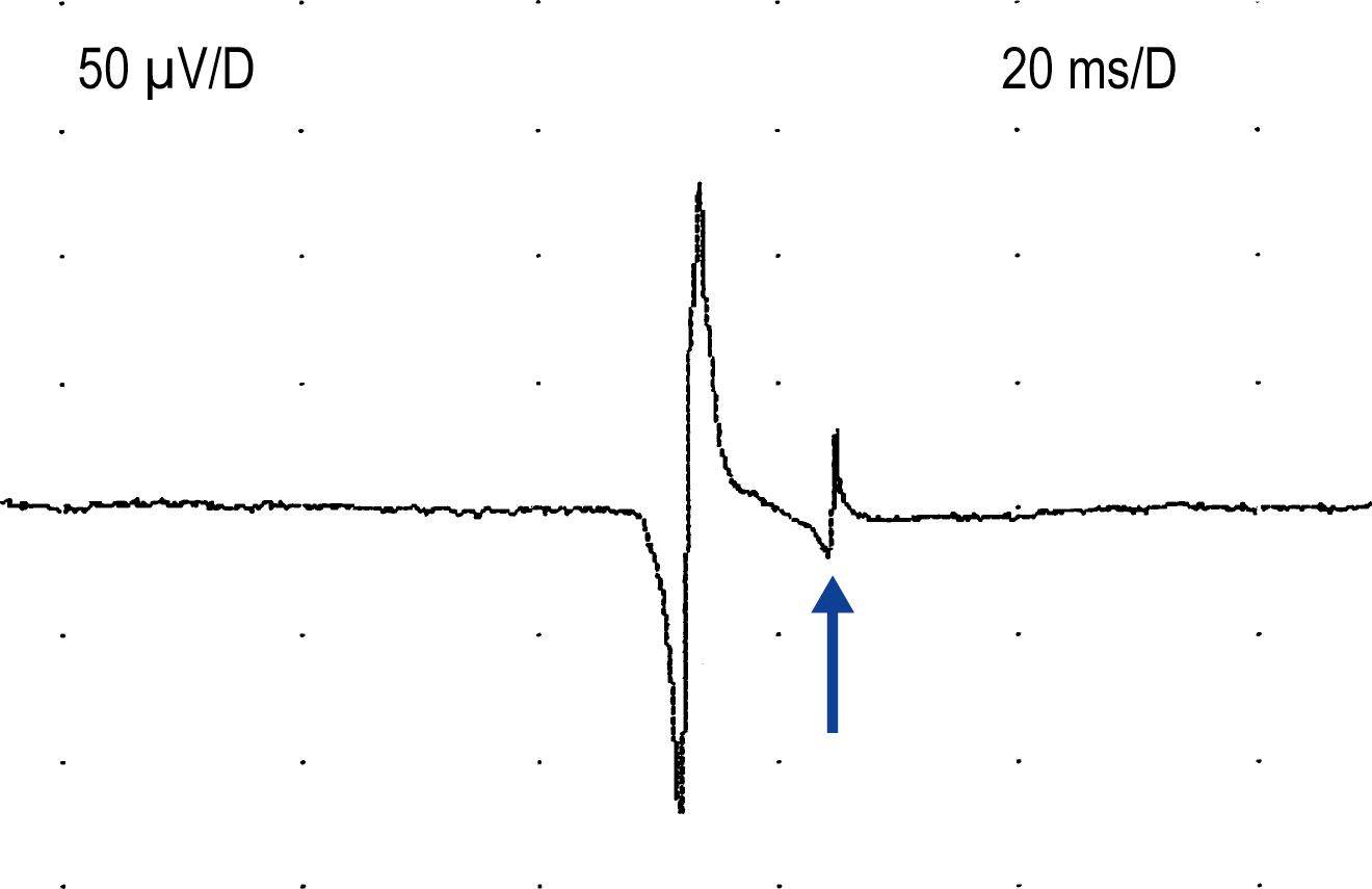 Basic Electromyography: Analysis of Motor Unit Action Potentials ...