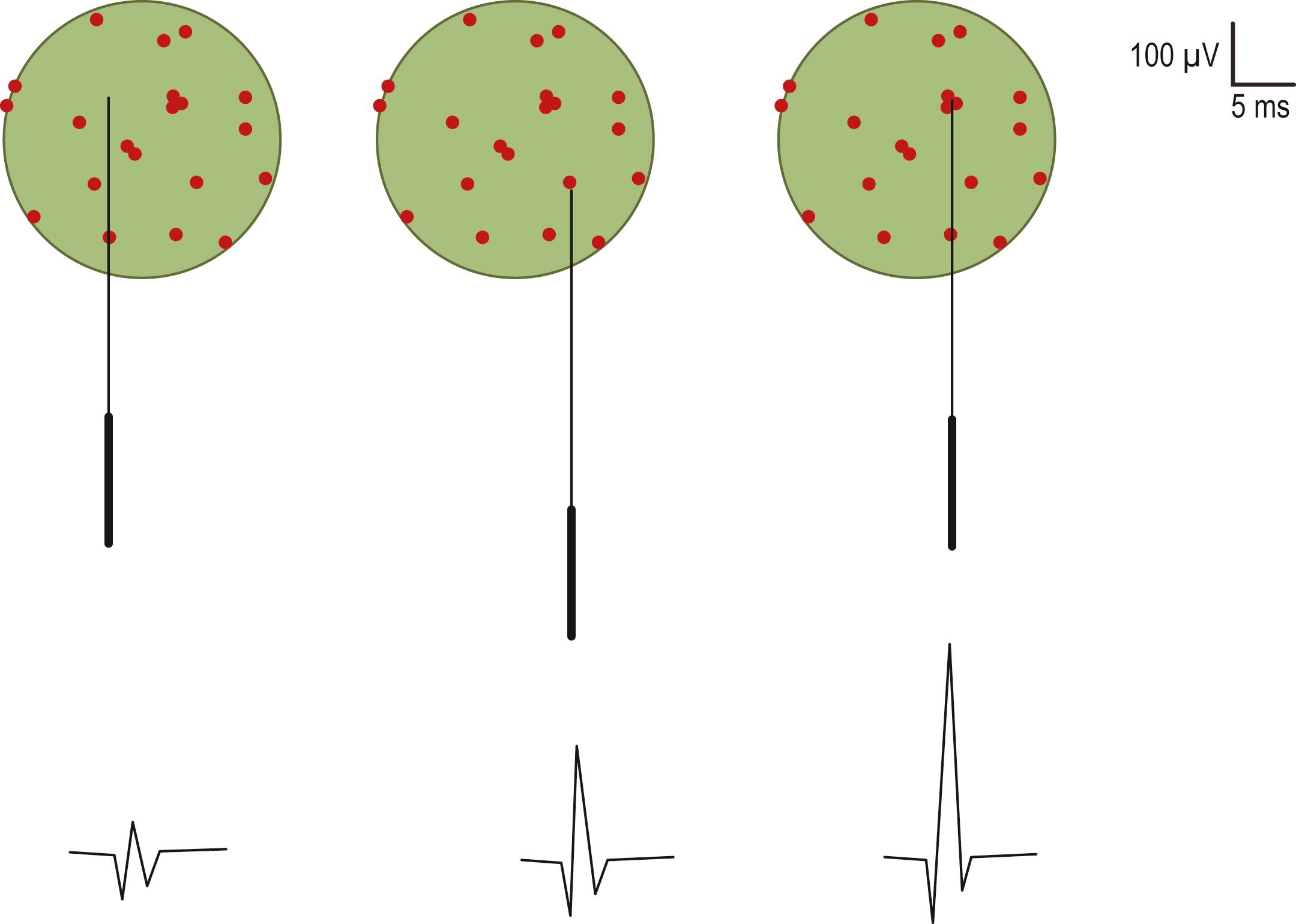 Basic Electromyography: Analysis of Motor Unit Action Potentials ...