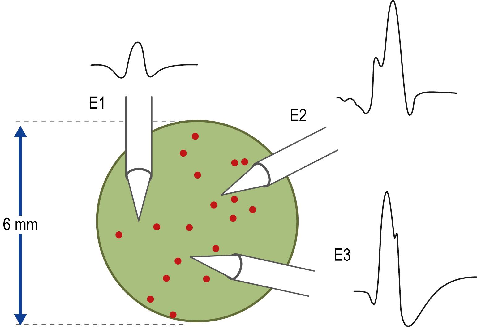 Basic Electromyography: Analysis of Motor Unit Action Potentials ...