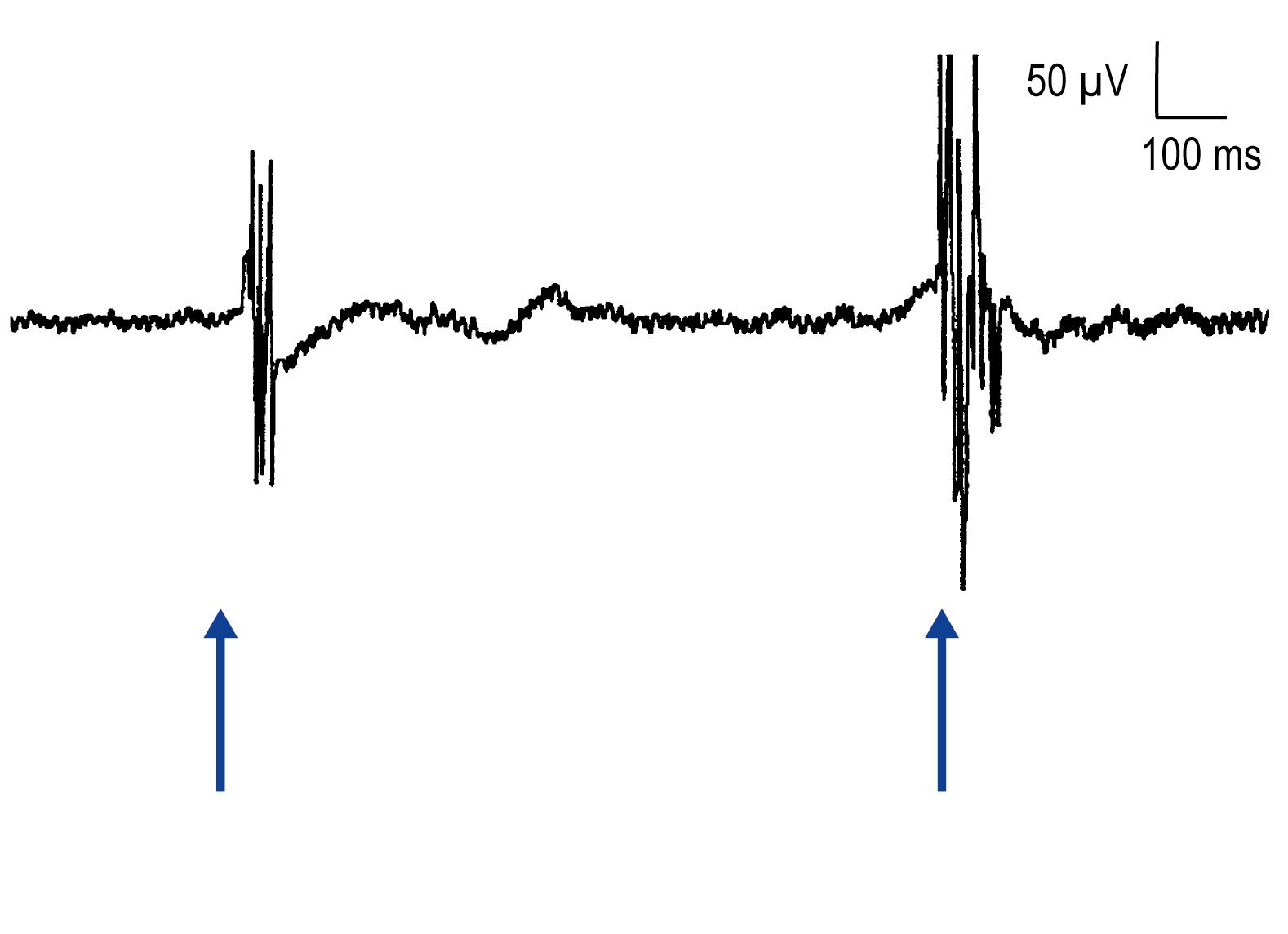 Basic Electromyography: Analysis of Spontaneous Activity - Clinical Tree