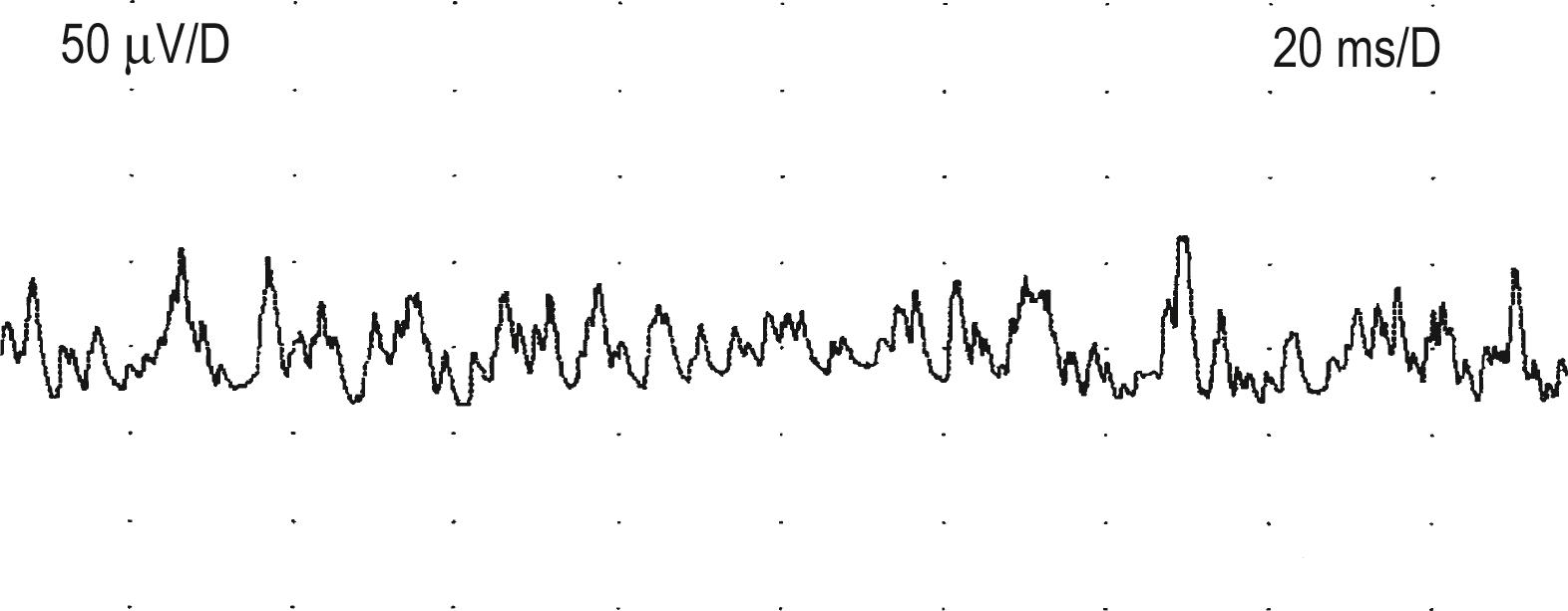 Basic Electromyography: Analysis of Spontaneous Activity - Clinical Tree