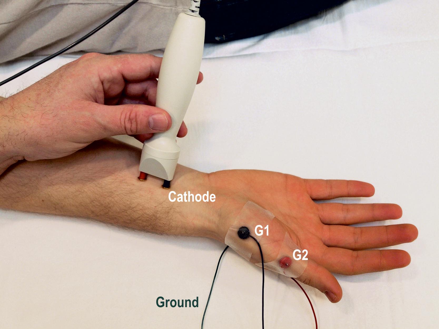 Basic Nerve Conduction Studies - Clinical Tree