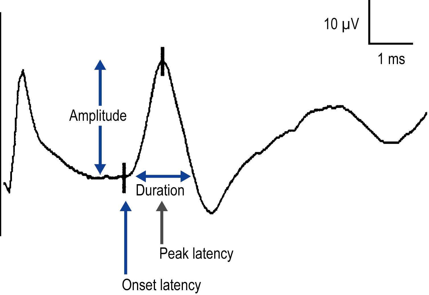 Basic Nerve Conduction Studies - Clinical Tree