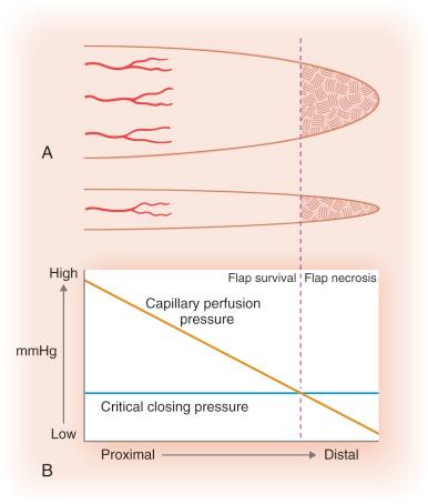 Basic Principles in Flap Reconstruction - Clinical Tree